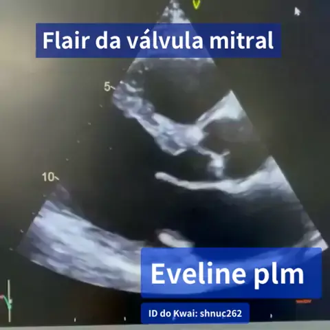 mitral flail valve | Discover